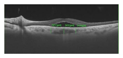 Enhanced Depth Imaging EDI OCT Demonstrates Subfoveal Choroidal