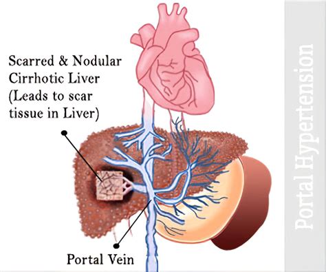 Portal Hypertension