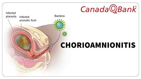 Chorioamnionitis Chorioamnionitis Crash Medical Review Series