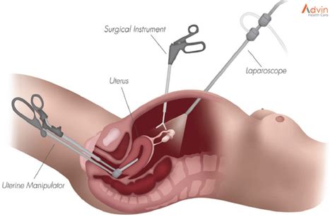 Vaginal Hysterectomy