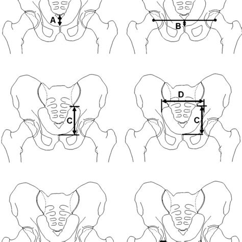 Pdf Estimation Of Pelvic Tilt On Anteroposterior X Rays A