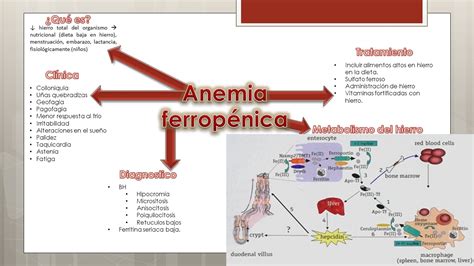 Hematología Anemia Por Deficiencia De Eritrocitos Anemia Ferropénica
