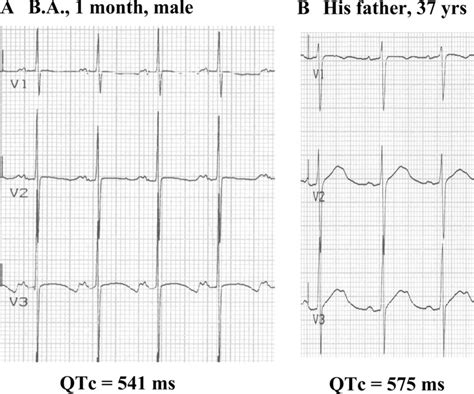 A ECG Tracing Of A Neonate With A Markedly Prolonged QT Interval Download Scientific Diagram