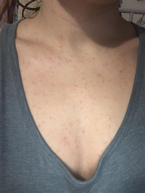 Sudden Breakout Only In Chest And Crawling Up Neck Slightly Irritated And Itchy I Was Just On