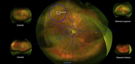 Optos Ultra Widefield Montage Image With 7 Field Outline Grid And 5 Download Scientific Diagram
