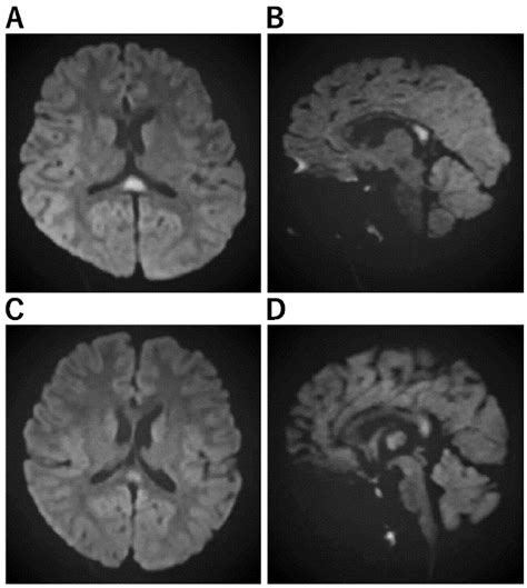 A Comprehensive Review Of Pediatric Acute Encephalopathy