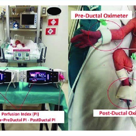 Photograph Of The Procedure To Measure The Perfusion Index And Its Download Scientific Diagram