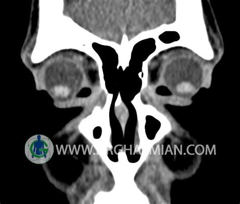 سی تی اسکن صورت و سینوس چیست و چرا انجام می شود؟ مرکز دکتر قائمیان