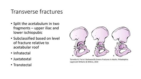 Acetabulum Fractures Anatomy Radiological Evaluation Classification And Management Pptx