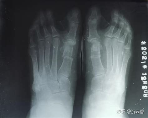 洛阳大脚骨病的“陷阱”，你中了几招？ 知乎