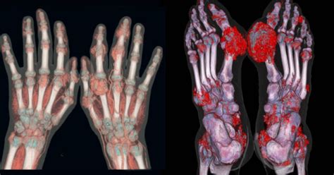 Дръжте нивата на пикочна киселина под контрол Последствията могат да бъдат необратими За Жената