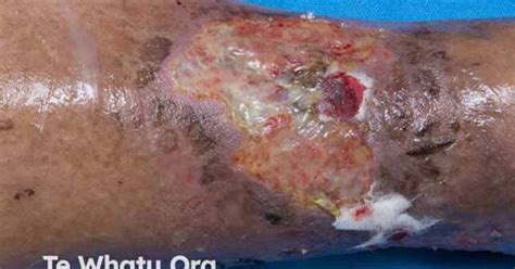 Pyoderma Gangrenosum Image