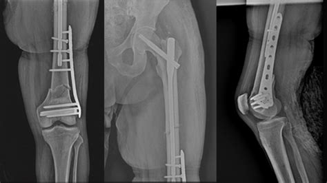 Trifocal Femur Fracture Where Do I Start A Surgical Challenge