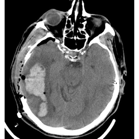 Ct Of The Head Immediately After A Right Sided Craniotomy Was Performed Download Scientific