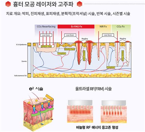 여드름흉터치료가격 대비 효과 좋은 피부과 네이버 블로그