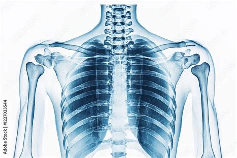 Detailed Human Chest X Ray Displaying Ribcage Spine And Shoulder
