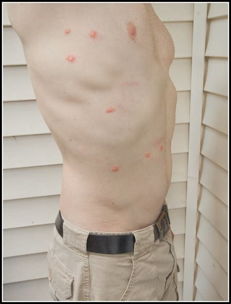 Chigger Bites On Stomach