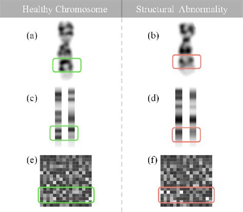 Figure 1 From Chromosomal Structural Abnormality Diagnosis By