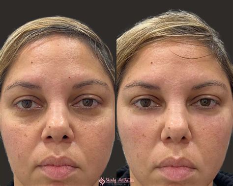 Under Eye Fillers Before And After Results At Skinly