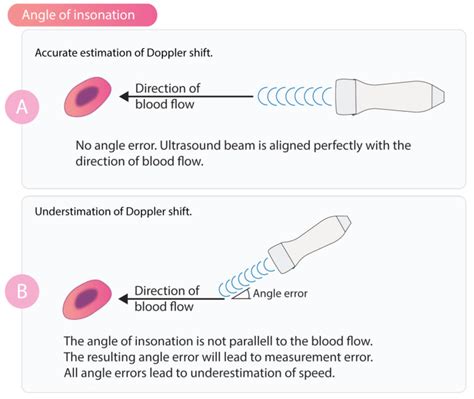 Doppler Effect And Doppler Echocardiography The Cardiovascular
