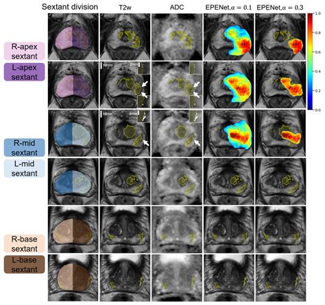 Epenet Predictions For Cancers With Extraprostatic Extension In One