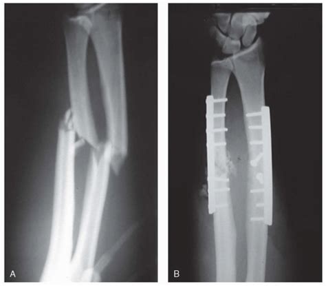 Open Reduction And Internal Fixation Of Forearm Fractures