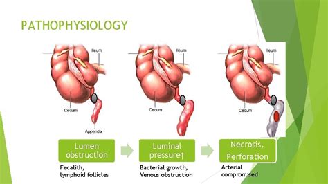 Acute Appendicitis Pathophysiology Lumen Obstruction Fecalith Lymphoid