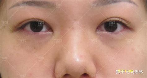 针式祛眼袋 知乎