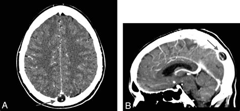 Large Arachnoid Granulations Involving The Dorsal Superior Arachnoid