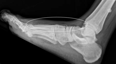 Necrotizing Fasciitis X Ray