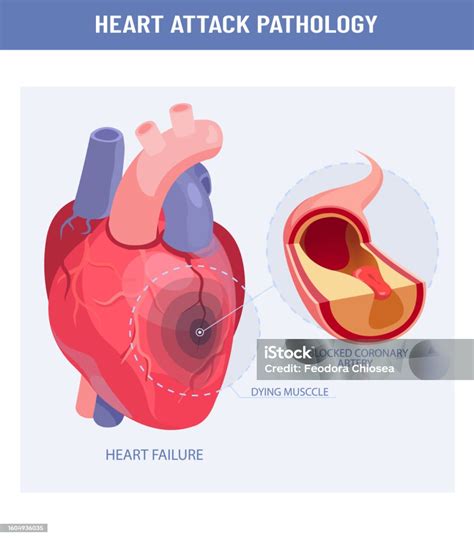 심장 마비 죽상 동맥 경화증 의료 그림 손상된 심장의 벡터 죽상 동맥 경화성 플라크가있는 관상 동맥의 단면 건강관리와 의술에 대한 스톡 벡터 아트 및 기타 이미지 Istock