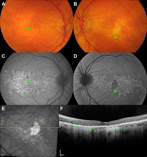 Late Onset Retinal Degeneration Opth