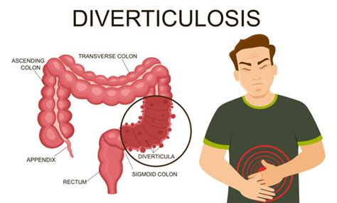 รูปภาพdiverticulitis เลือกดูภาพถ่ายสต็อก เวกเตอร์ และวิดีโอ2 069 Adobe Stock
