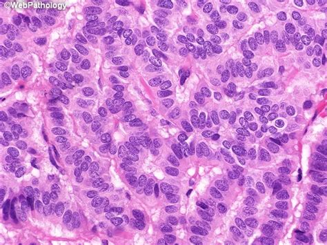 Well Differentiated Neuroendocrine Tumor