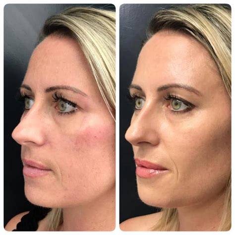 Hollow Cheeks Laser Skin Care