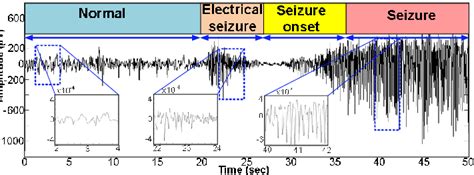 Intracerebral Eeg Recordings Of A Patient With Refractory Focal Download Scientific Diagram