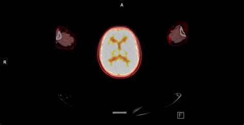 Lymphome De Hodgkin Et Incidentalome Thyroïdien