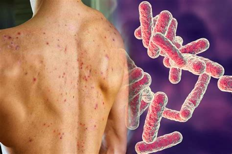 5 Worst White Food For Blood Poisoning And Septicemia Infection Blood