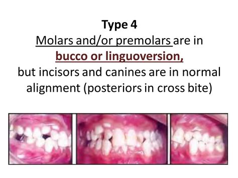 Update Classification Of Malocclusion Updatedpdf