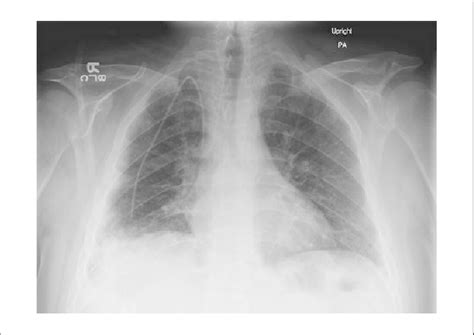 Admission Chest X Ray Of Patient 2 Bilateral Nodular Densities Most Download Scientific
