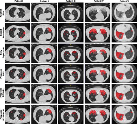 figure 1 from computerized medical imaging and graphics active deep learning from a noisy