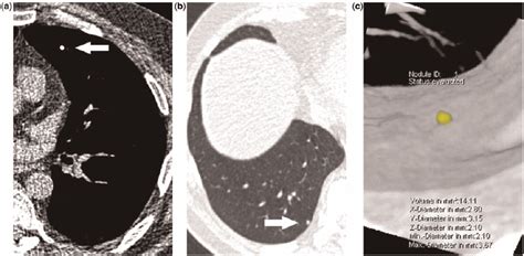 A Complete Calcified Nodule Is Considered As Benign On A Transverse Download Scientific Diagram