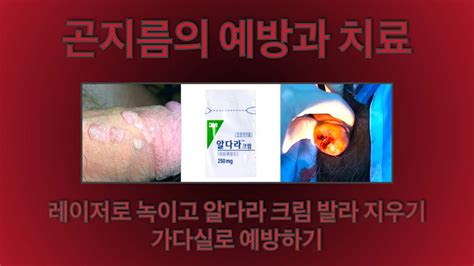 곤지름 남자 성기에 브로콜리가 자라는 병 가다실9 이용 예방 곤지름 치료 크림 Co2 레이저 이용 제거 Youtube