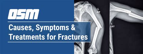 Causes Symptoms And Treatments For Fractures Orthopedic And Sports Medicine