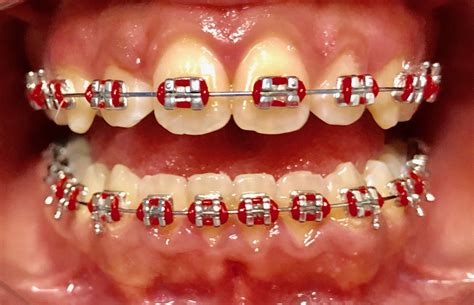 Pin By Vmrr On B R A C E S Braces Colors Cute Braces Cute Braces Colors