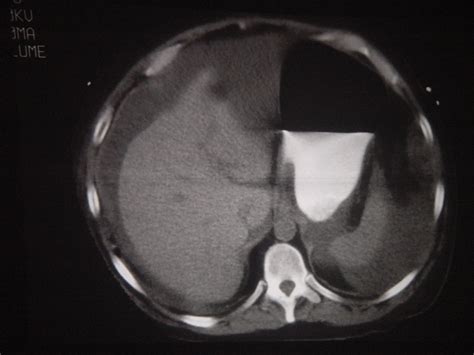 Pseudomembranous Colitis Surgery Photos