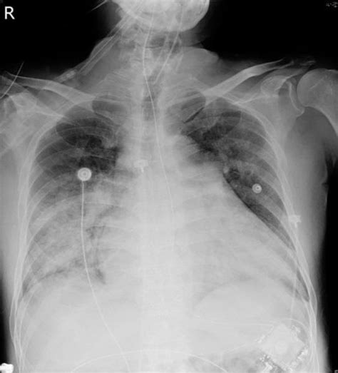 Diffuse Interstitial Fluffy Opacity Consistent With Clinical Pulmonary