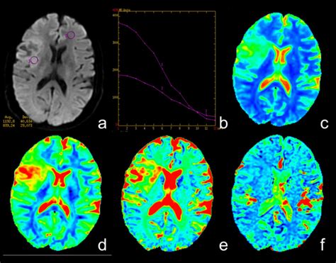 Optimum Engaging People With A Common Brain Cancer Nci