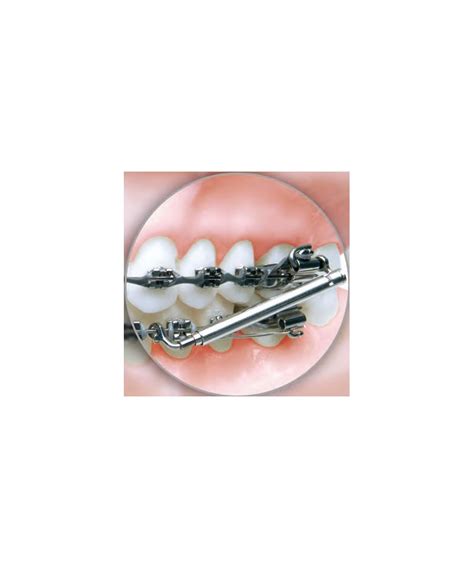 Class 2 Orthodontic Malocclusion Corrector