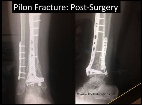 Pilon Fracture Footeducation